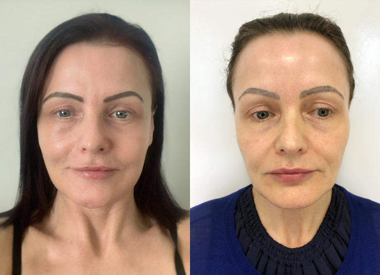 Facelift – Dr Carlo Debbas