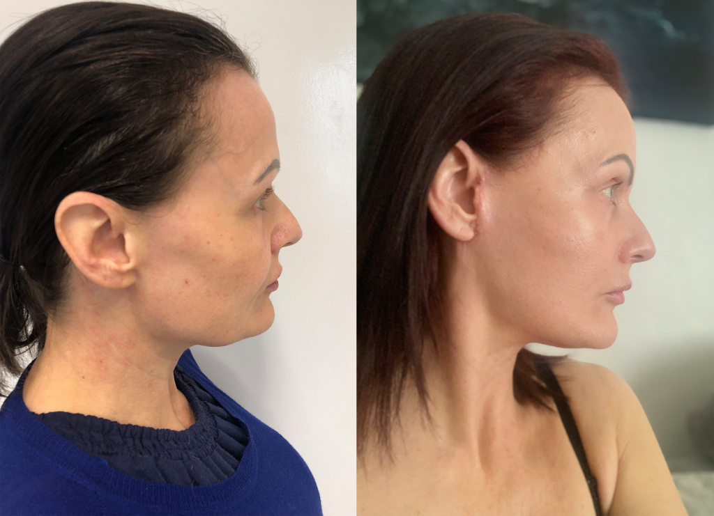 Facelift – Dr Carlo Debbas